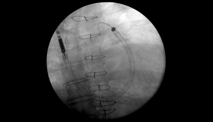 Impella RP Flex™ IJ Insertion into Cadaver | HeartRecovery.com